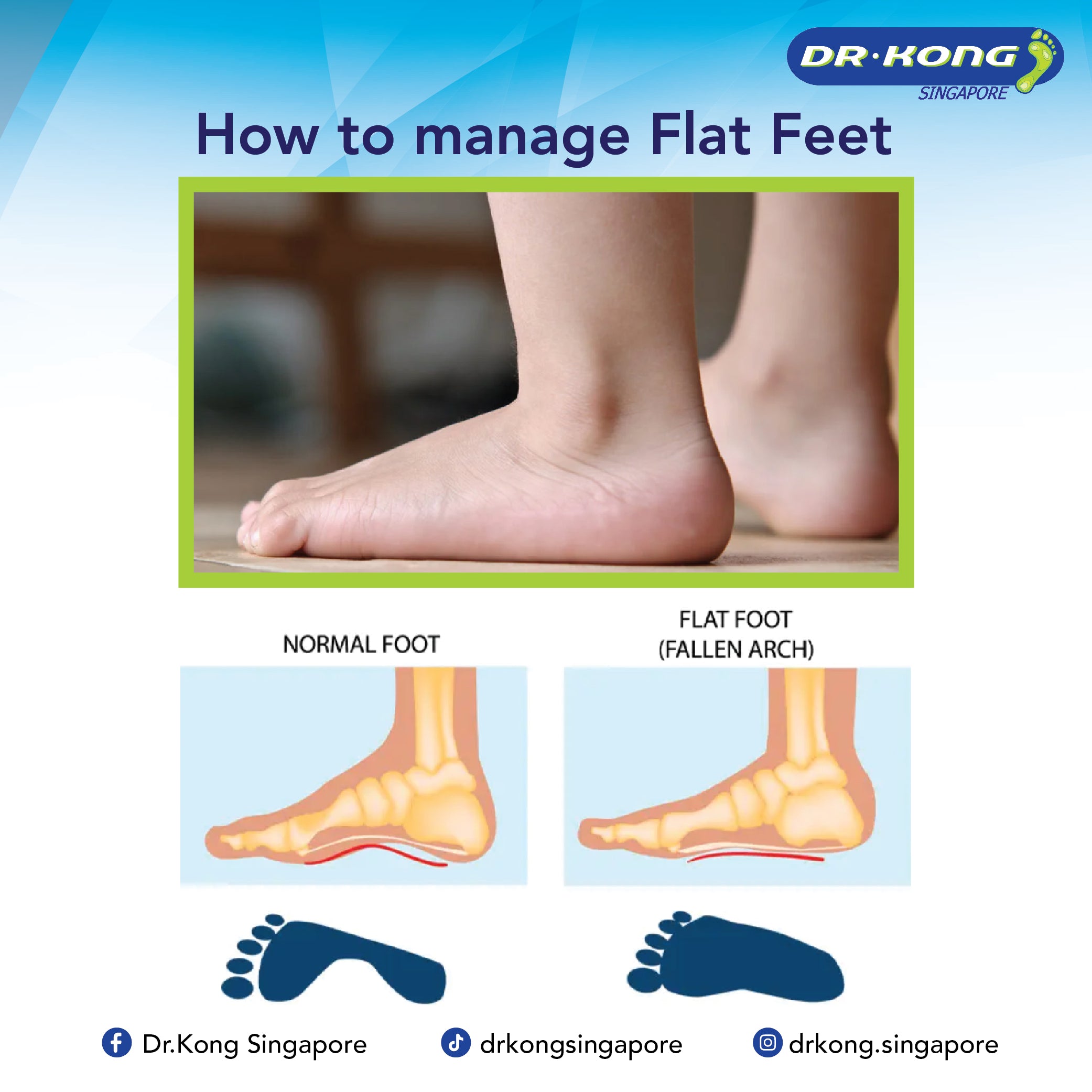 Flat Feet Diagnosis and treatment – Dr Kong Official